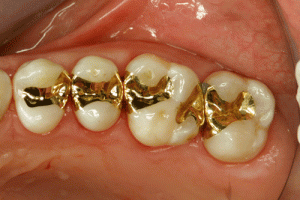 Gold Inlays & Onlays - Dentist Sawston
